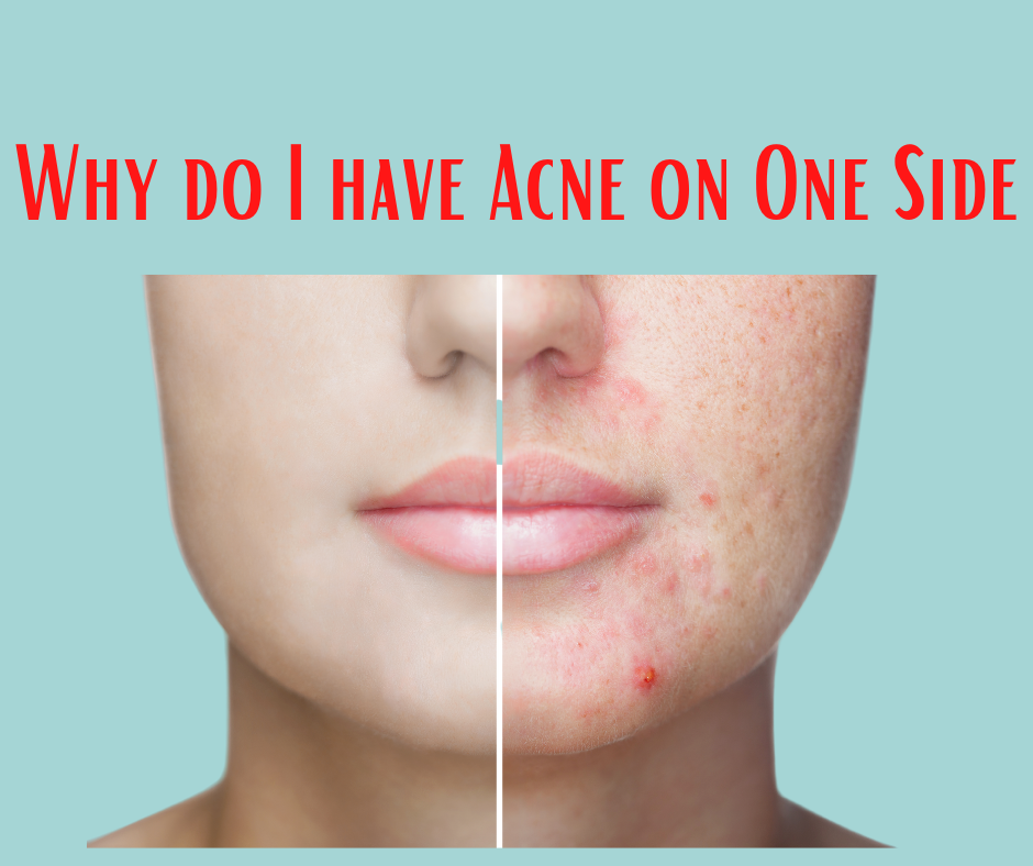 I have acne on just one side of my face, what does this mean? – scentsofman